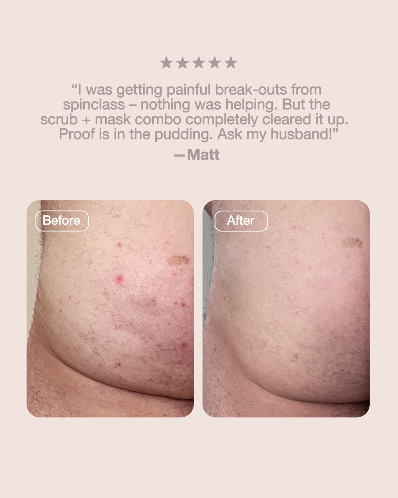 The Butt Facial™ Bundle - Buttface